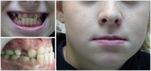 Il est préférable de consulter tôt : l’appareillage orthodontique ...