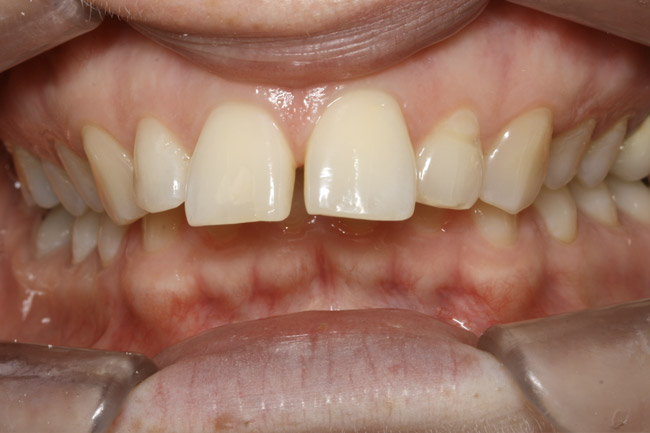 Mâchoire du bas en retrait et autres décalages : quelle orthodontie