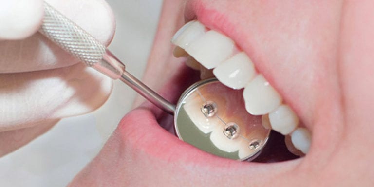 Invisalign ou Lingual, quel traitement choisir