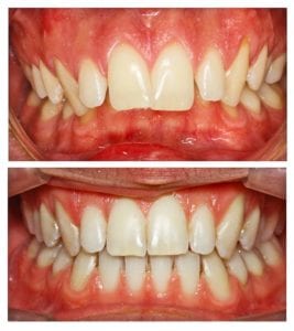 Photo n°1 : Vue intrabuccale avant et après traitement