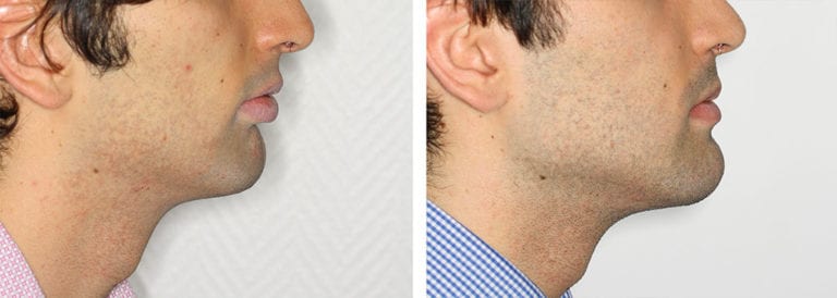 Photo n°2 : Vue du profil du patient avant et après chirurgie