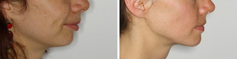 Photo n°2 : Vue du profil de la patiente avant et après chirurgie