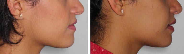 Photo n°2 : Vue du profil du patient avant et après chirurgie.